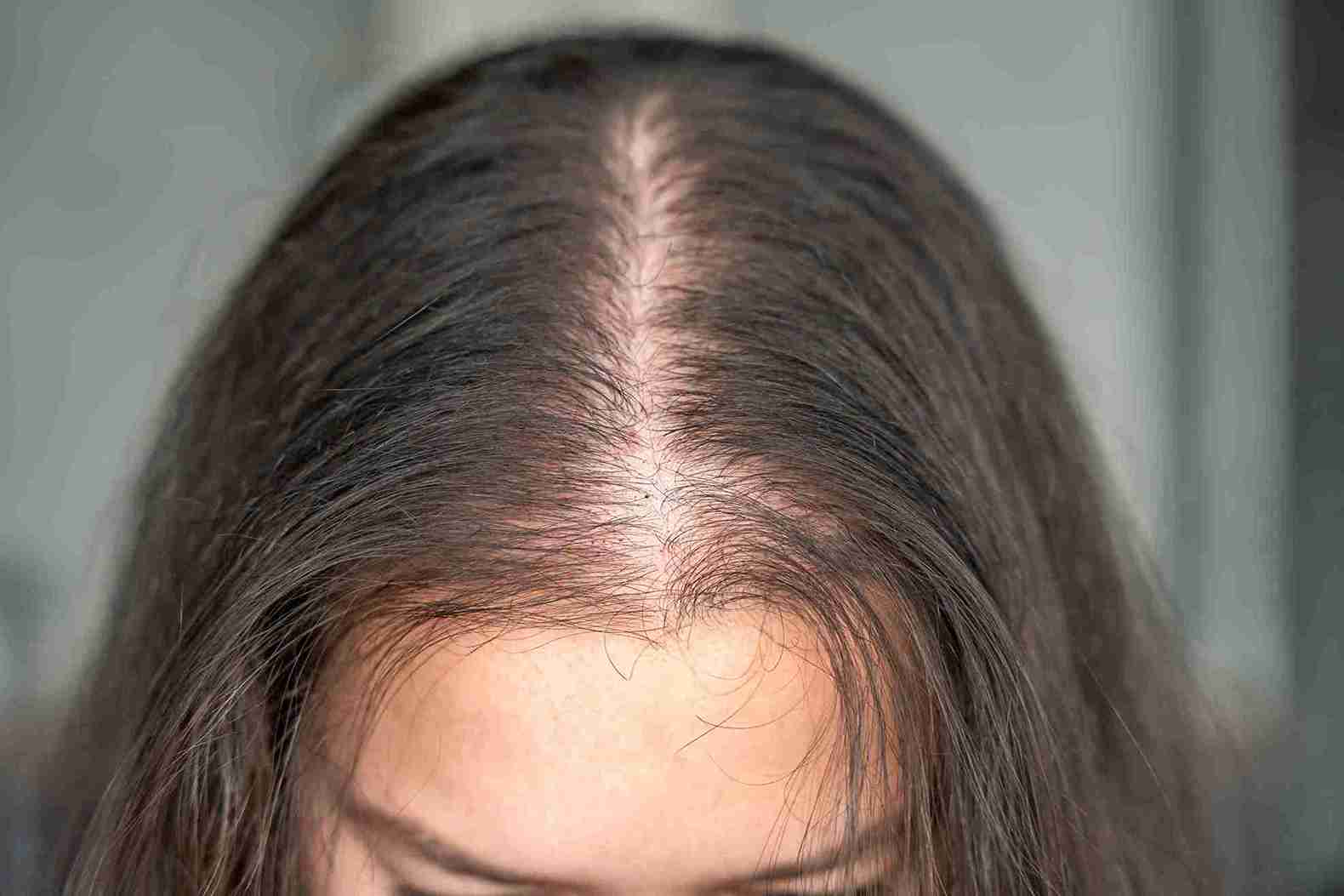 Causes of Hair Loss in Women: What You Should Know - Asli Tarcan Clinic