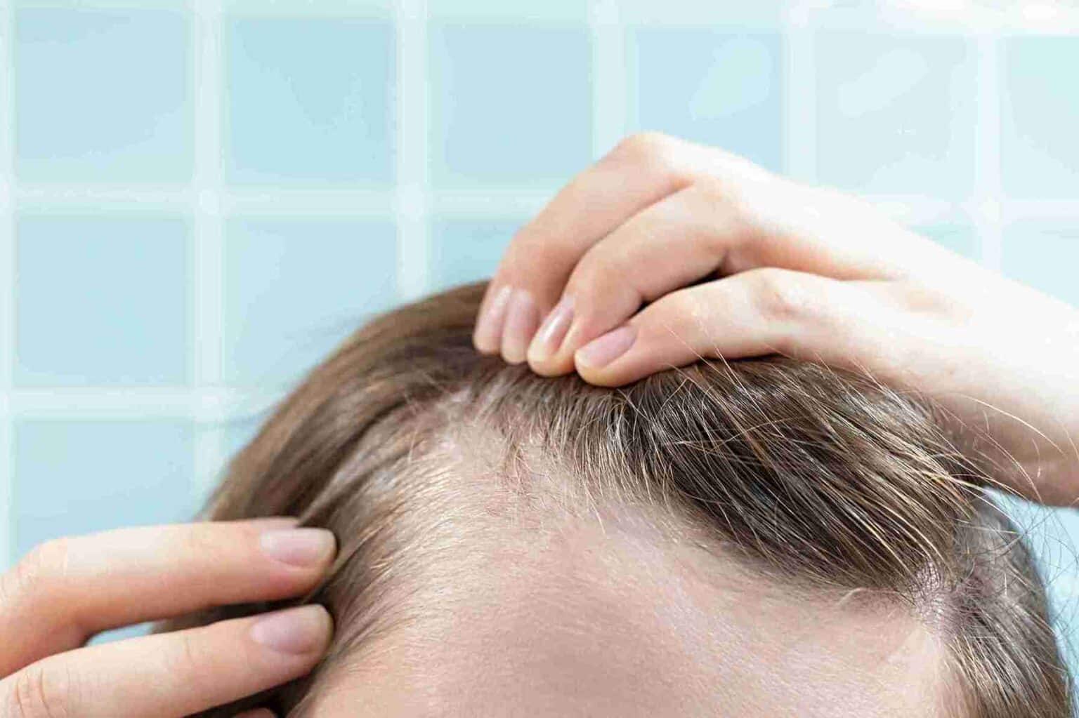Causes of Hair Loss in Men - Asli Tarcan Clinic